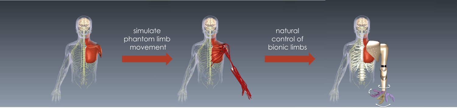 New prosthetic technology lets you control artificial arms as your own ...